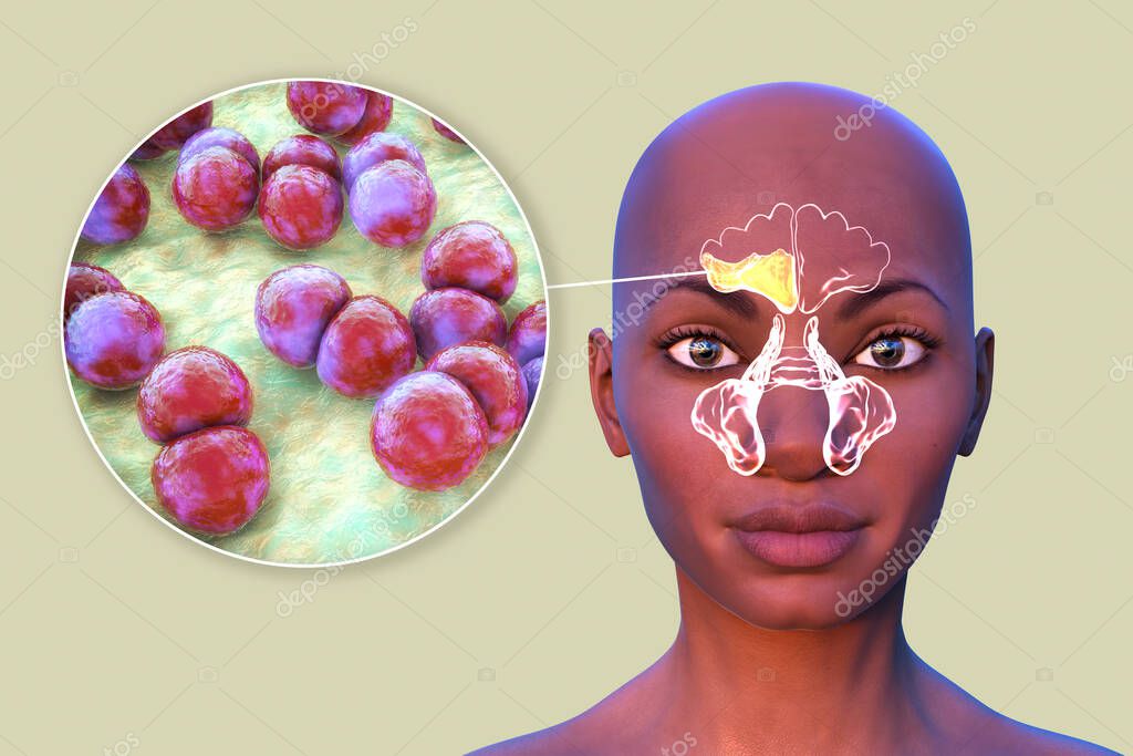 Sinusitis, inflamación de las cavidades paranasales. Ilustración 3D que ...