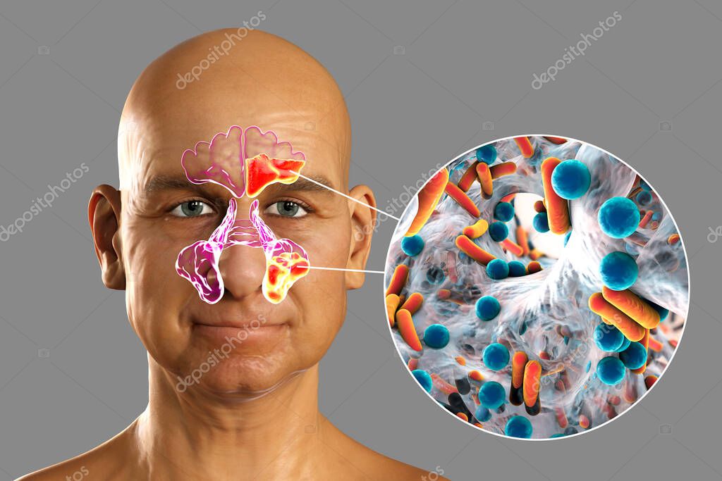Sinusitis, inflamación de las cavidades paranasales. Ilustración 3D que muestra inflamación ...