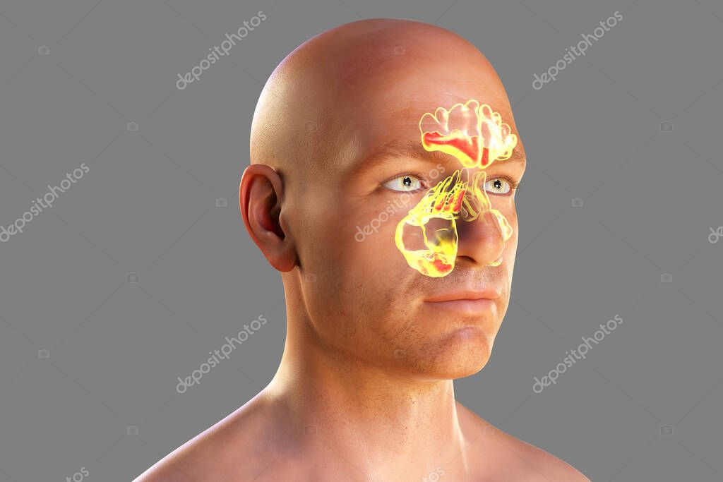 Sinusitis, inflamación de las cavidades paranasales. Ilustración 3D que muestra inflamación ...