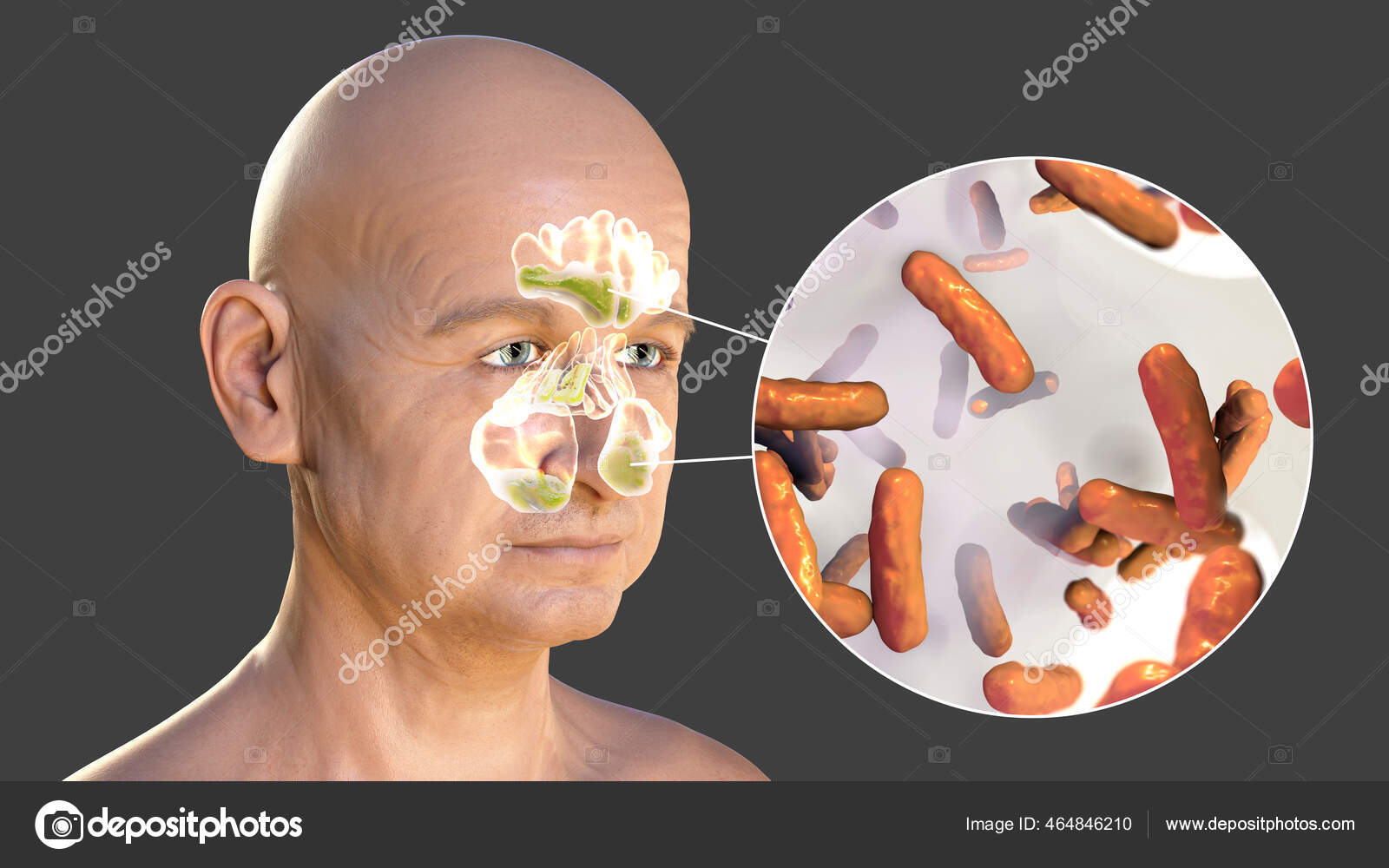 Infeccao Pulmonar Por Pseudomonas Diagnóstico E Tratamento Da