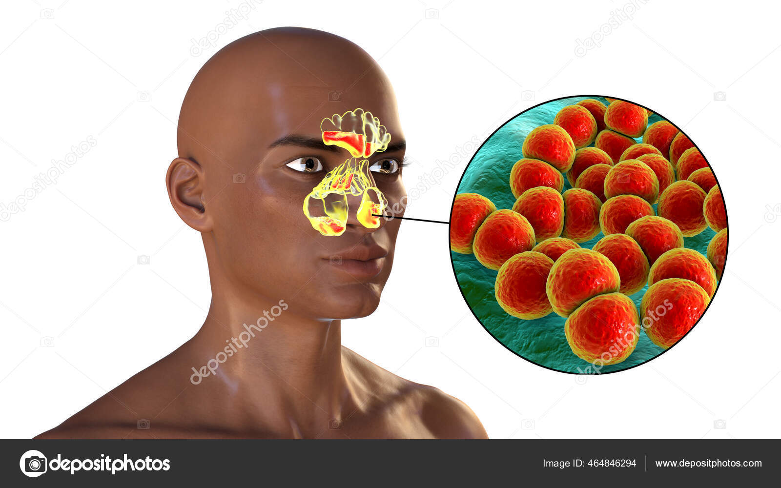 Streptococcus Pneumoniae Bacteria Cause Sinusitis Illustration Showing ...