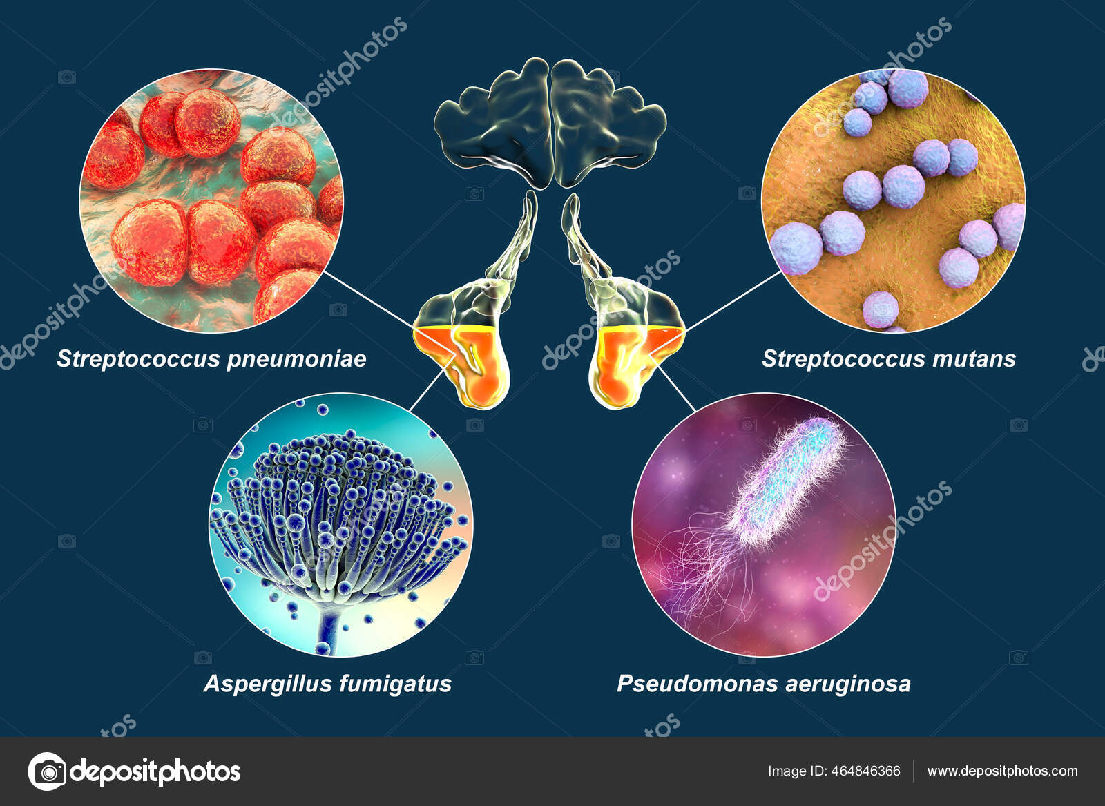Anatomi Rinosinuit Och Mikroorganismer Som Orsakar Sinuit Streptococcus ...