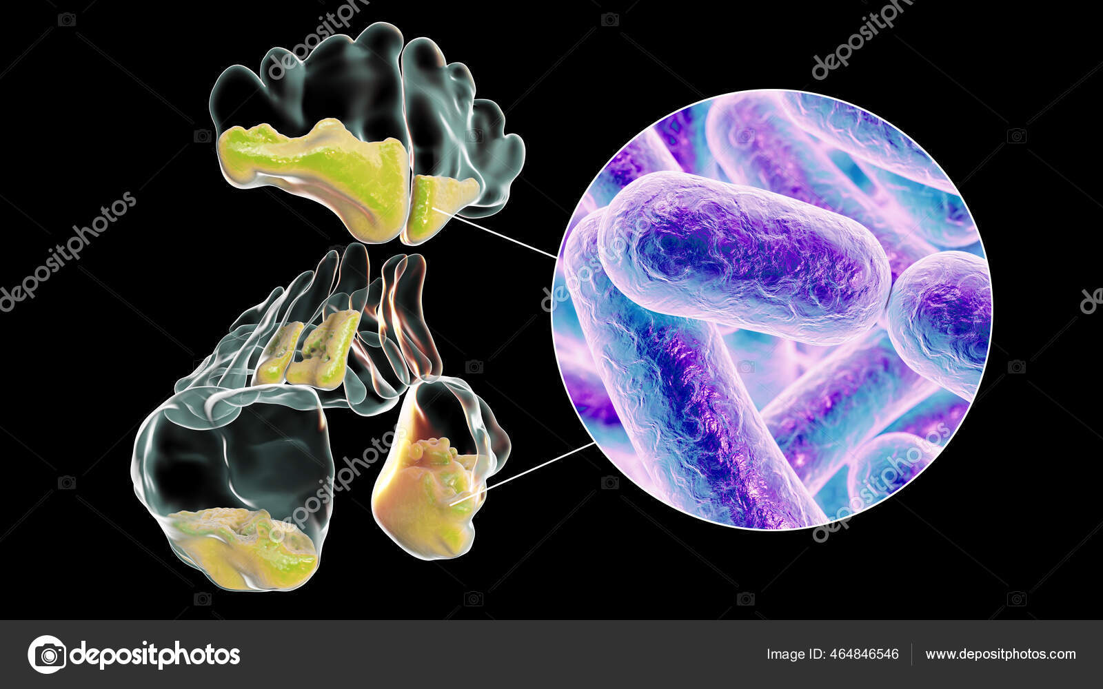 Sinüzit Paranasal Boşlukların Iltihaplanması Boyutlu Illüstrasyon Üst ...