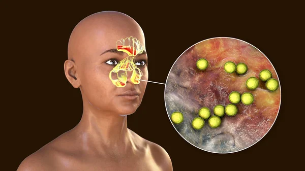 Streptococcus Pneumoniae Bacteria Cause Sinusitis Illustration Showing ...