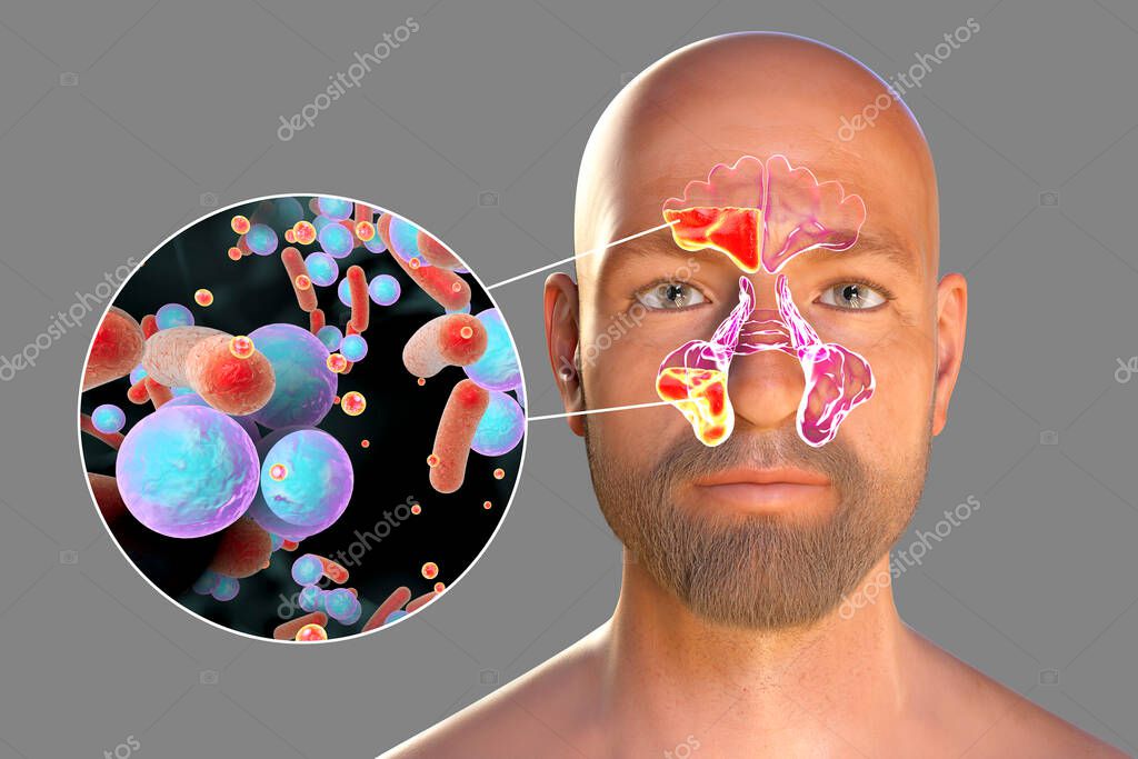 Sinusitis Inflamación Las Cavidades Paranasales Ilustración Que Muestra ...