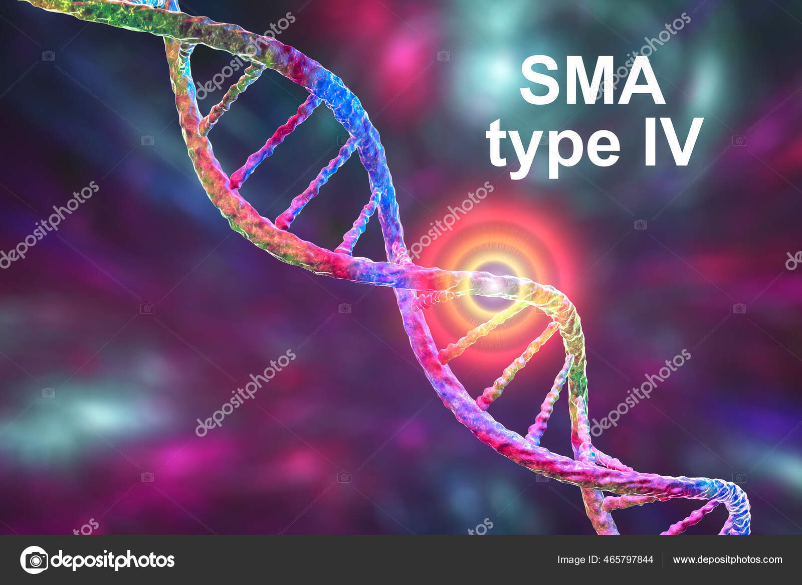 Spinal Muscular Atrophy Sma Type Genetic Neuromuscular Disorder ...