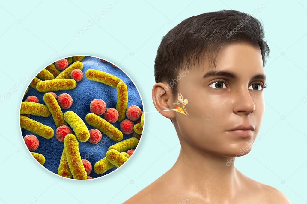 Otitis media, enfermedad inflamatoria del oído medio, ilustración 3D ...