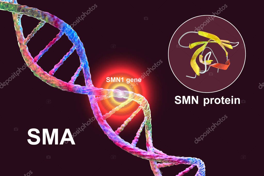 Atrofia muscular espinal, SMA, un trastorno neuromuscular genético con ...