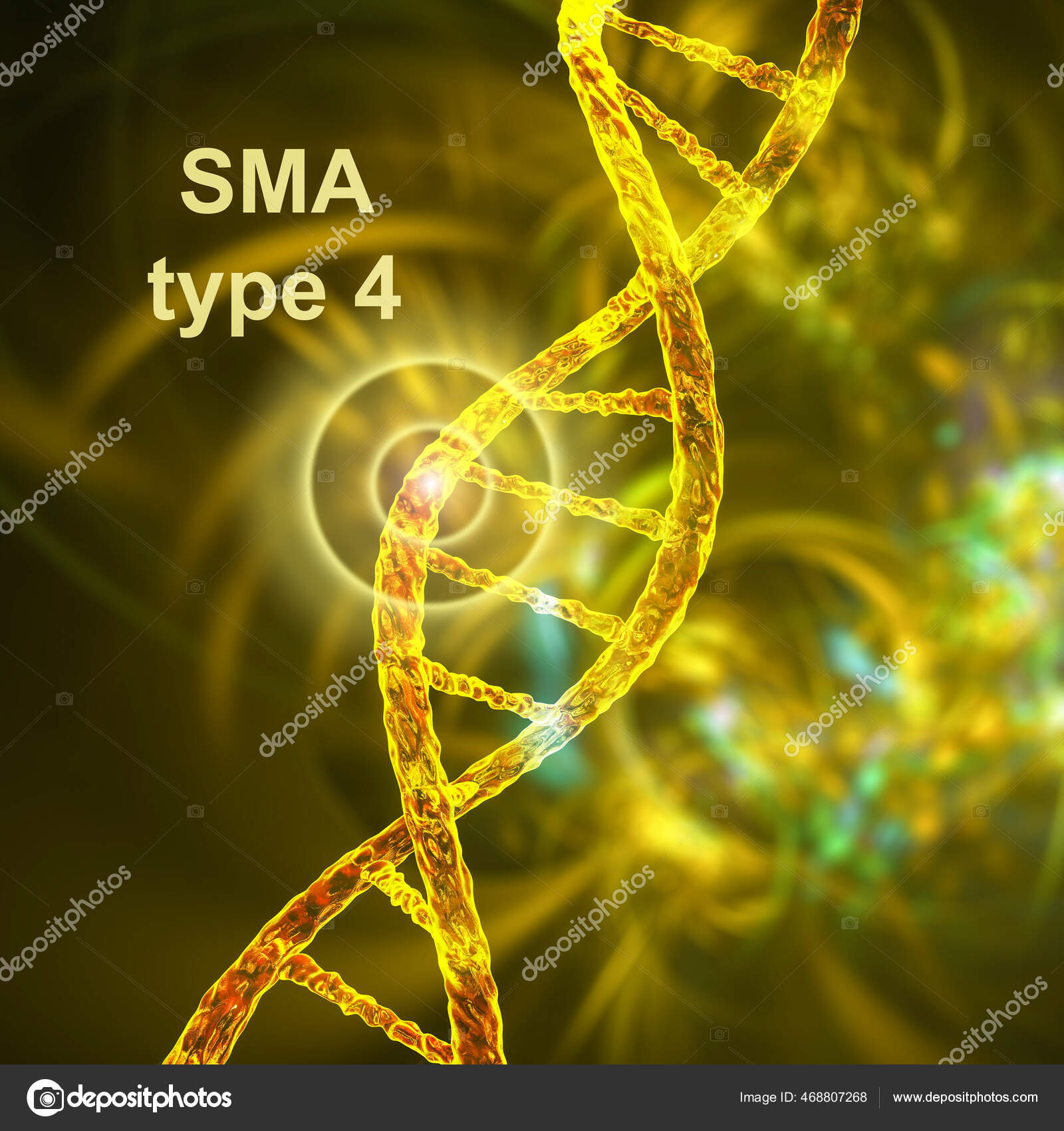 Atrofia Muscular Espinal Sma Tipo Trastorno Neuromuscular Genético Con ...