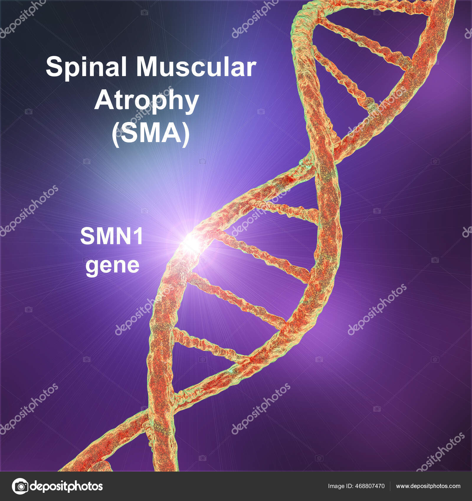 Spinal Muscular Atrophy Sma Genetic Neuromuscular Disorder Progressive ...