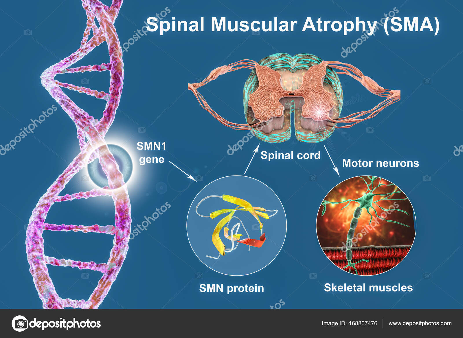 Atrofia Muscular Espinal Sma Trastorno Neuromuscular Genético Con ...