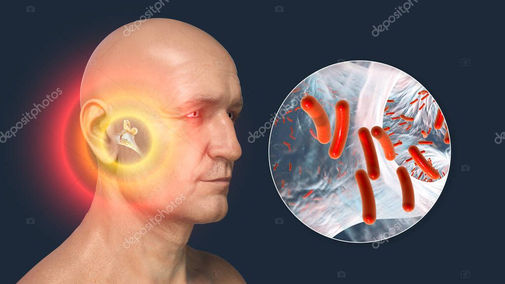 Otitis media, enfermedad inflamatoria del oído medio, ilustración 3D ...