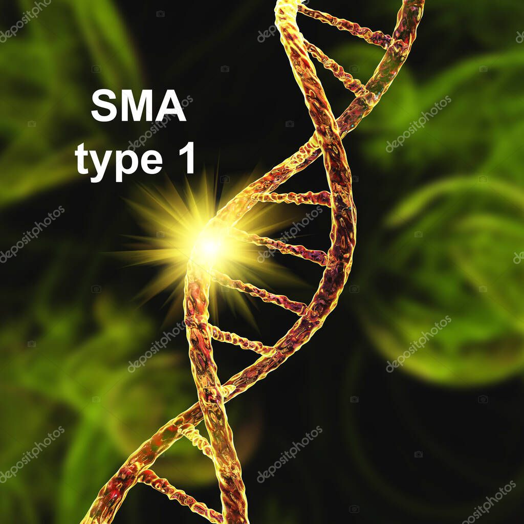 Atrofia muscular espinal, SMA, tipo 1, un trastorno neuromuscular ...
