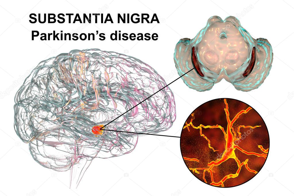 Sustancia negra del cerebro medio en la enfermedad de Parkinson ...