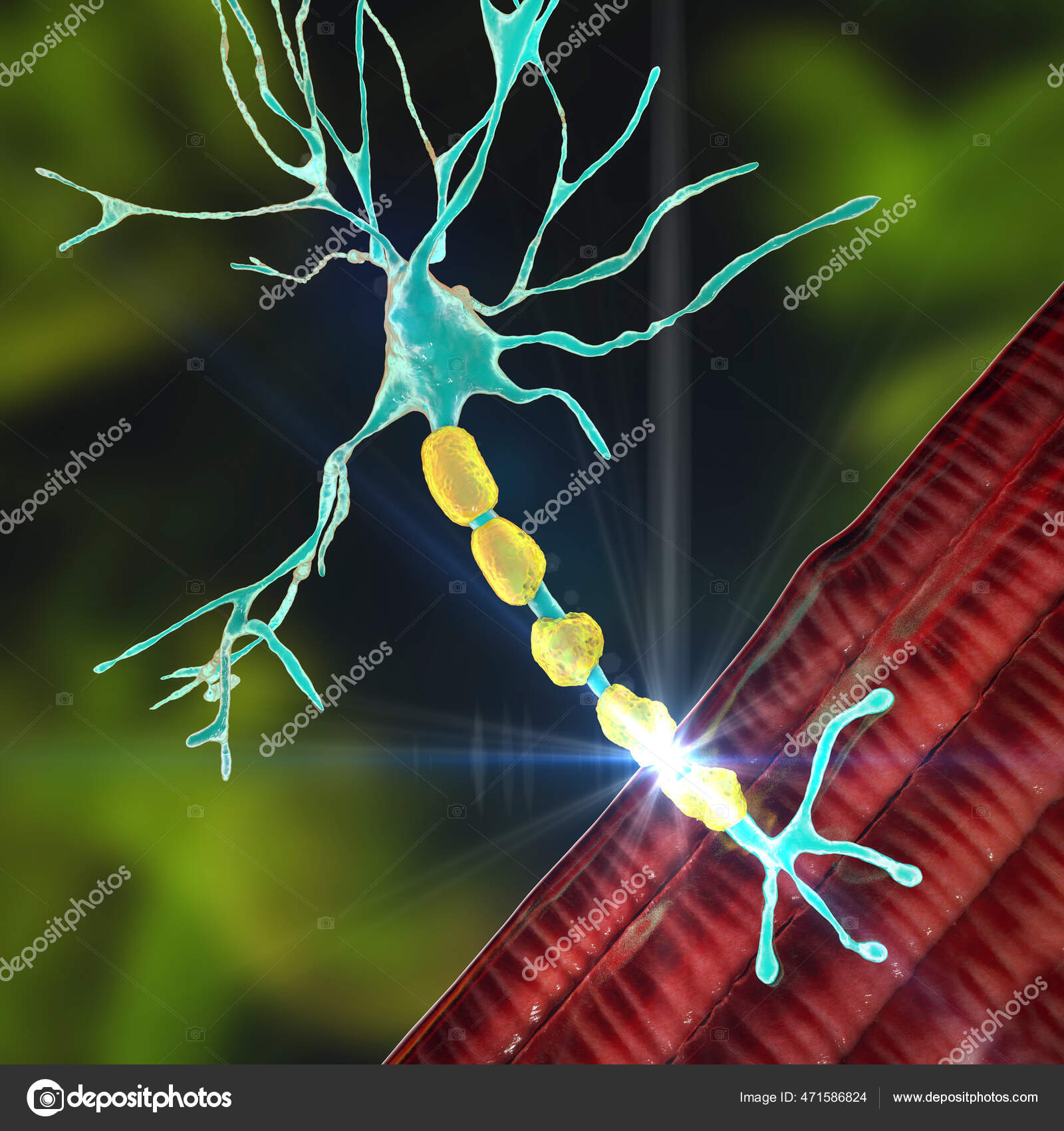 Desmielinización Neurona Daño Vaina Mielina Neuronal Visto Enfermedades ...