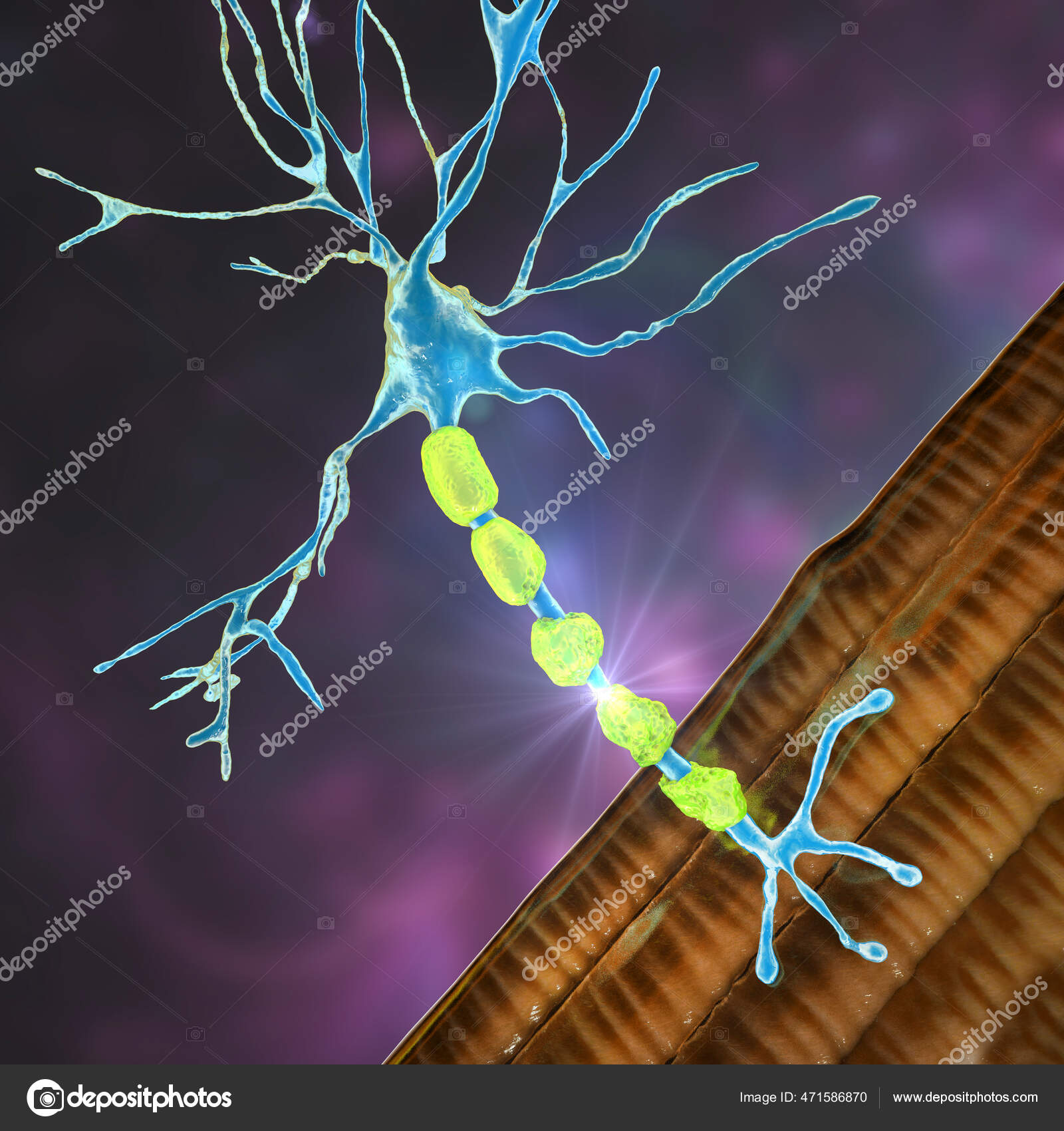 Demyelination Neuron Damage Neuron Myelin Sheath Seen Demyelinating ...