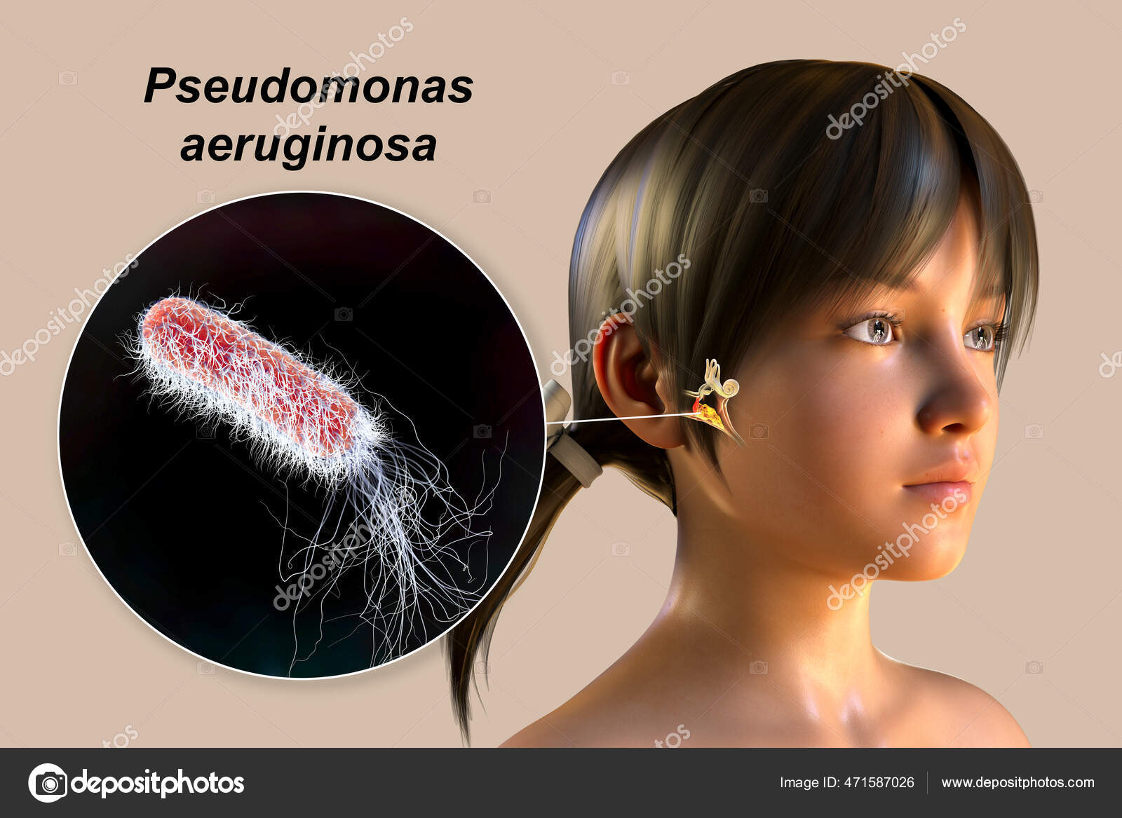 Infeccao De Ouvido Por Pseudomonas