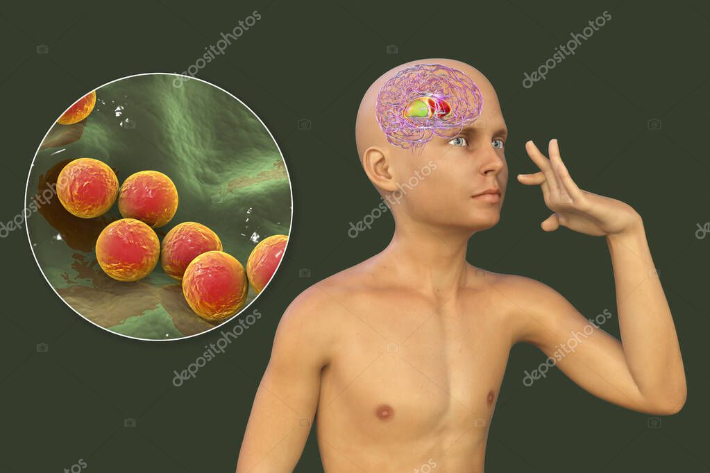 Corea de Sydenham, una enfermedad autoinmune que resulta de la ...