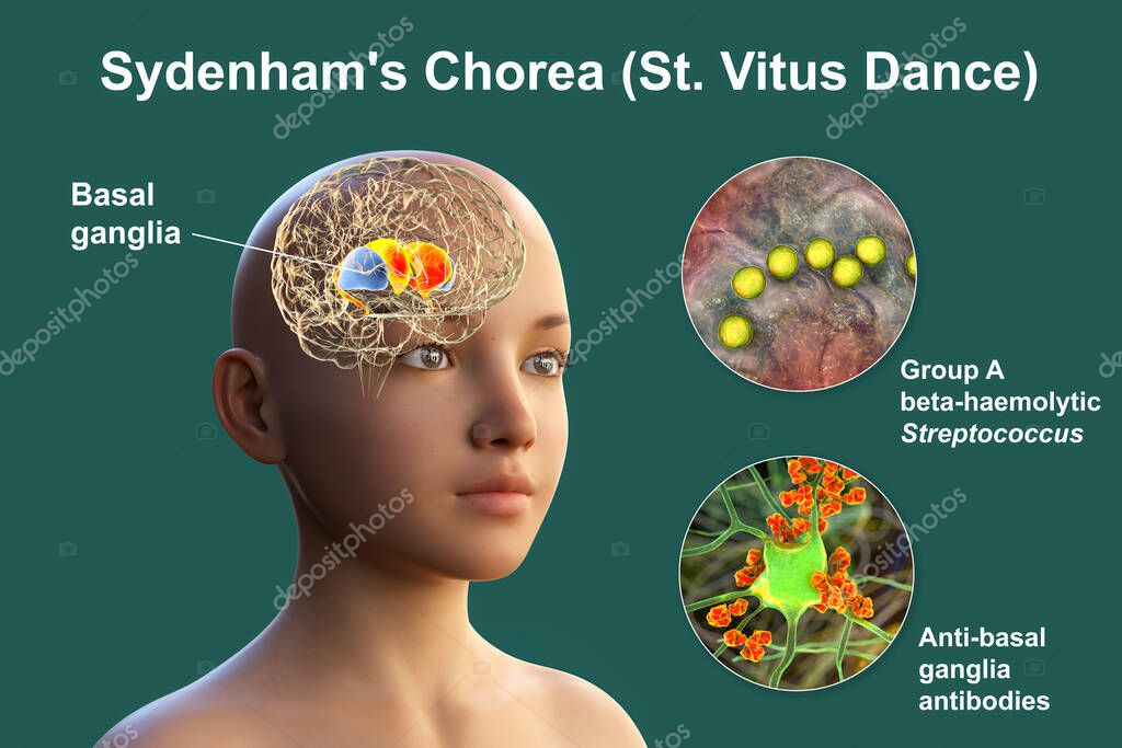 Corea de Sydenham, una enfermedad autoinmune que resulta de la ...