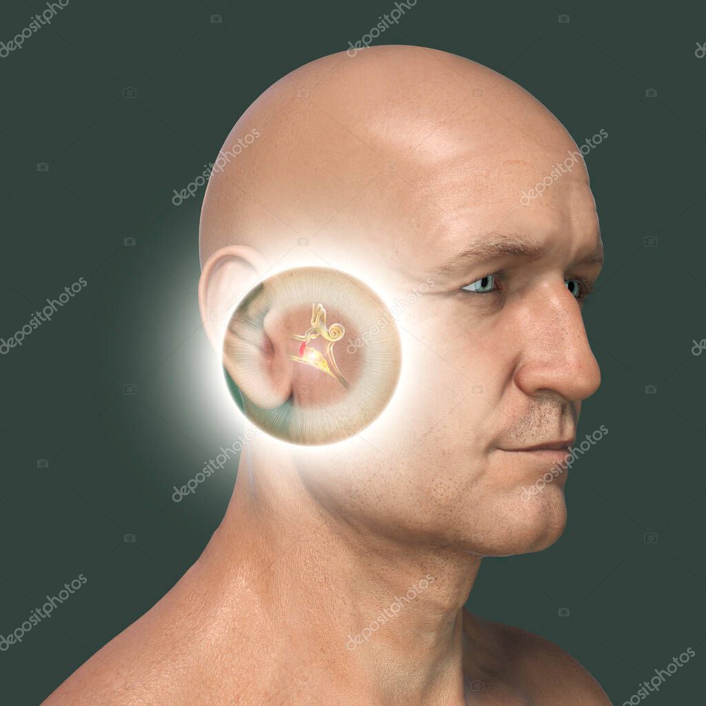 Otitis media, un grupo de enfermedades inflamatorias del oído medio ...