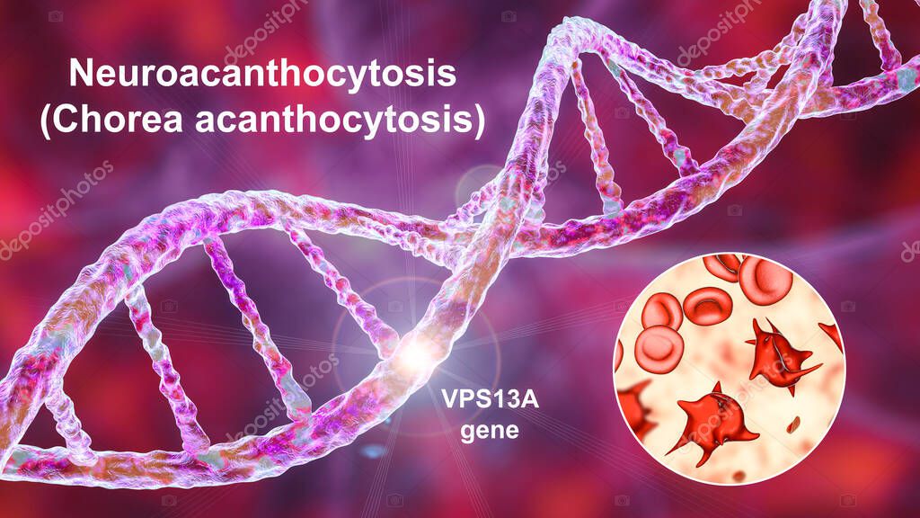 Neuroacantocitosis, corea acantocitosis, una enfermedad ...