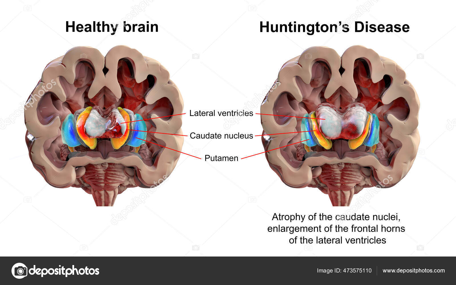 Dorsal Striatum Lateral Ventricles Healthy Brain Huntington's Disease ...