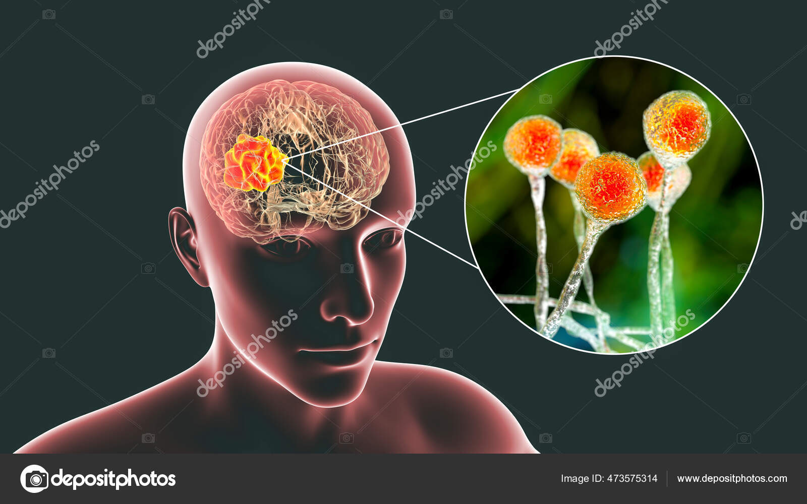 Brain Mucormycosis Brain Lesion Caused Fungi Mucor Also Known Black ...
