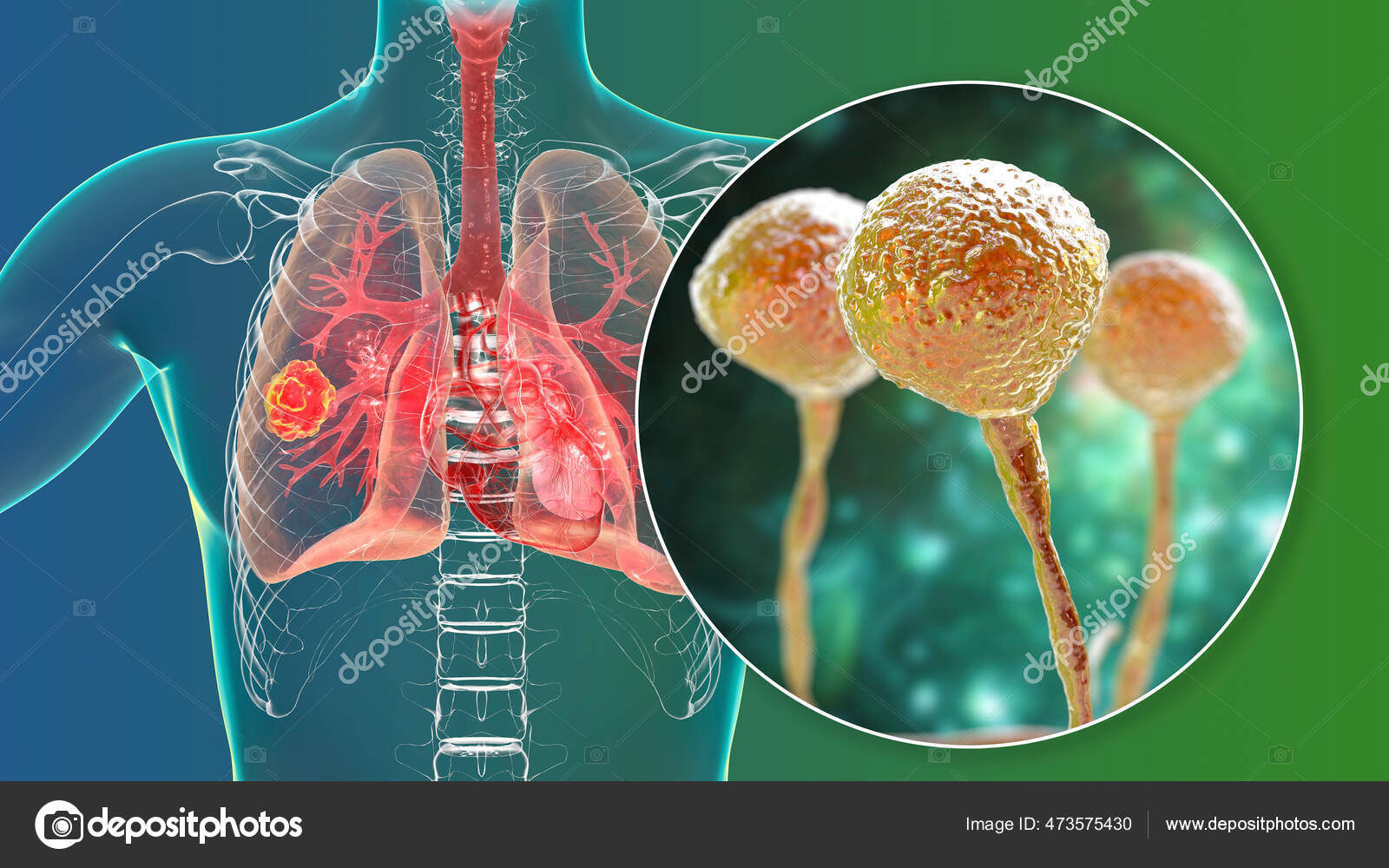 Lung Mucormycosis Lung Disease Caused Fungi Mucor Also Known Black ...