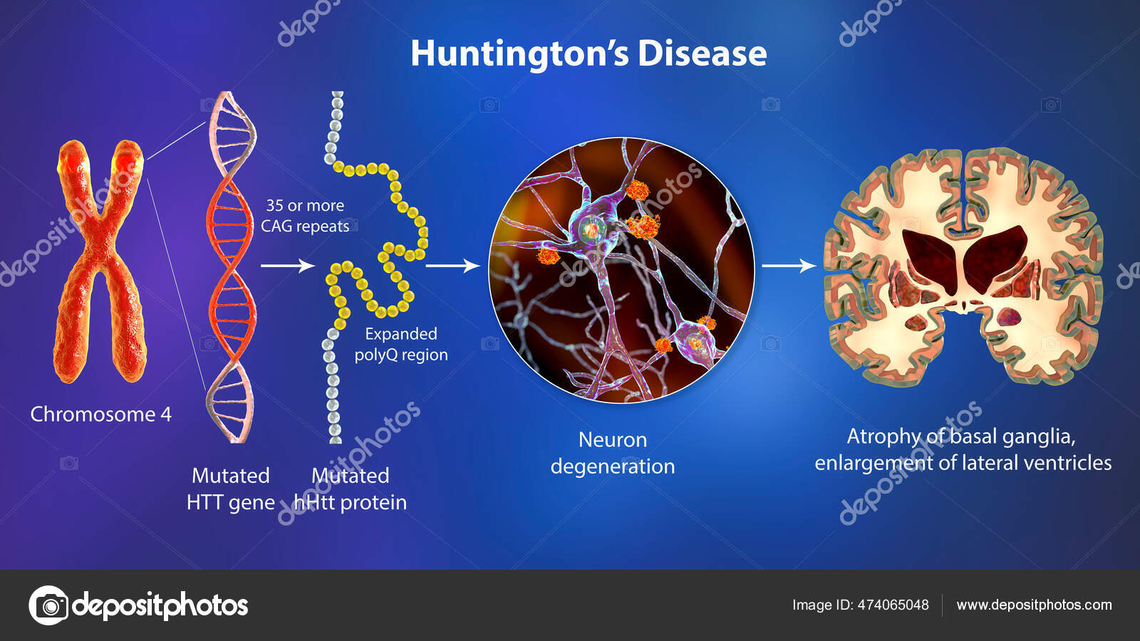 Genesis Molecular Enfermedad Huntington Ilustración Expansión Secuencia ...