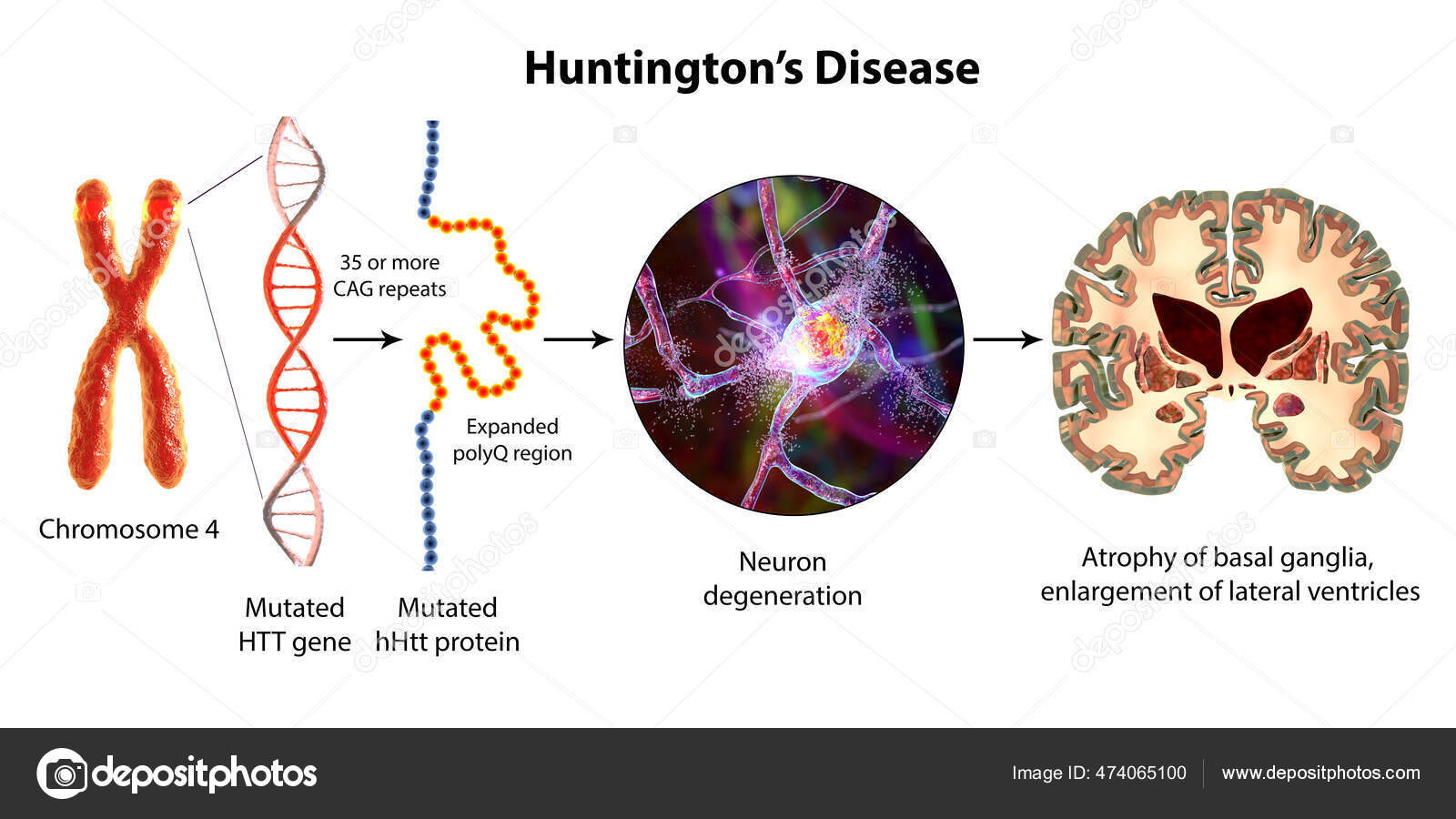 Molecular Genesis Huntington's Disease Illustration Expansion Cag ...