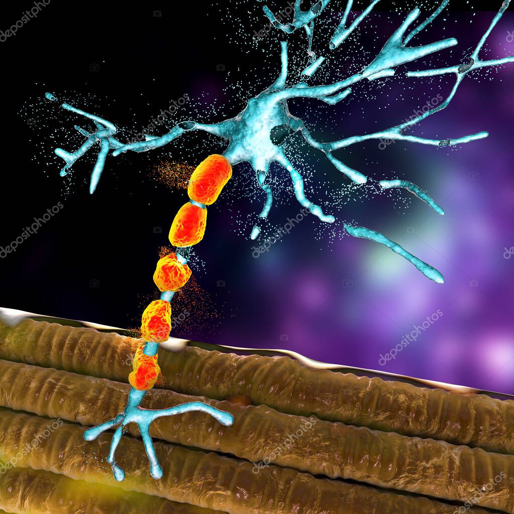 Degradación de las neuronas motoras, ilustración conceptual 3D. Las ...