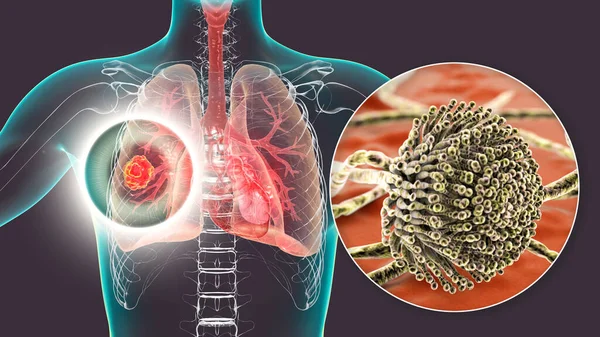 Pulmonary Cryptococcosis Invasion Lung Tissue Yeast Fungi Cryptococcus ...