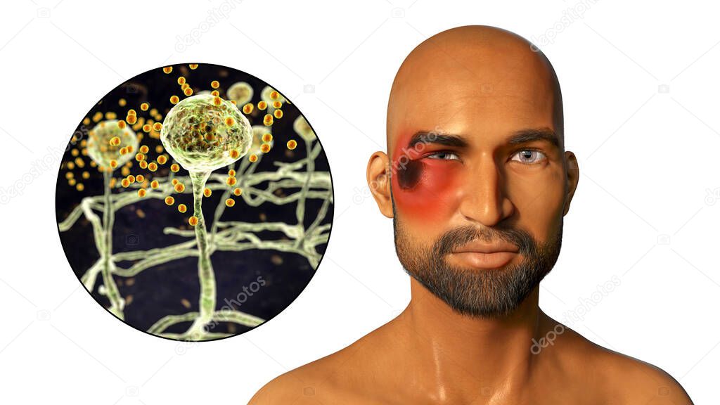 Forma cutánea periorbital de la mucormicosis, una enfermedad causada ...