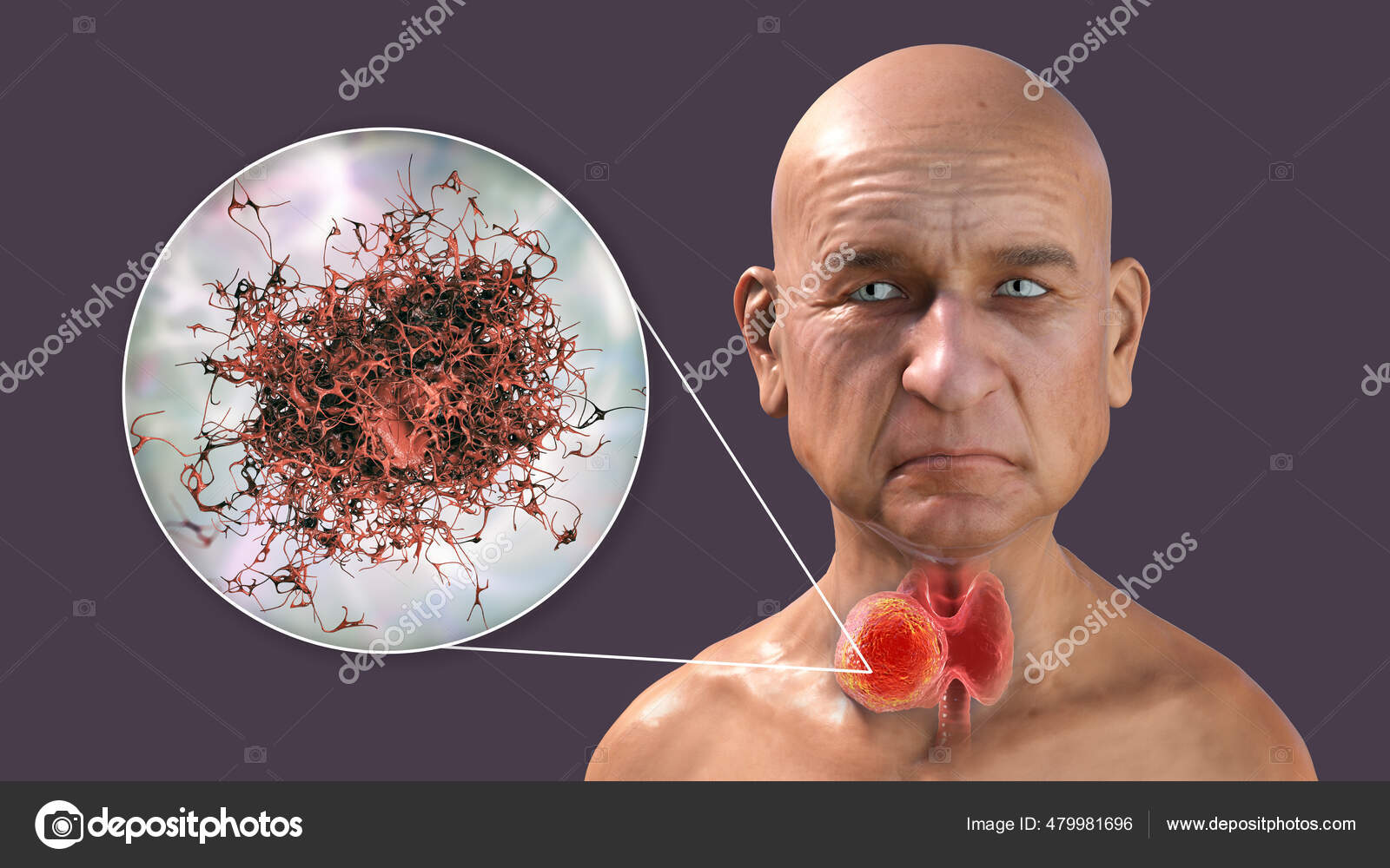Thyroid Cancer Illustration Showing Thyroid Gland Tumor Human Body ...