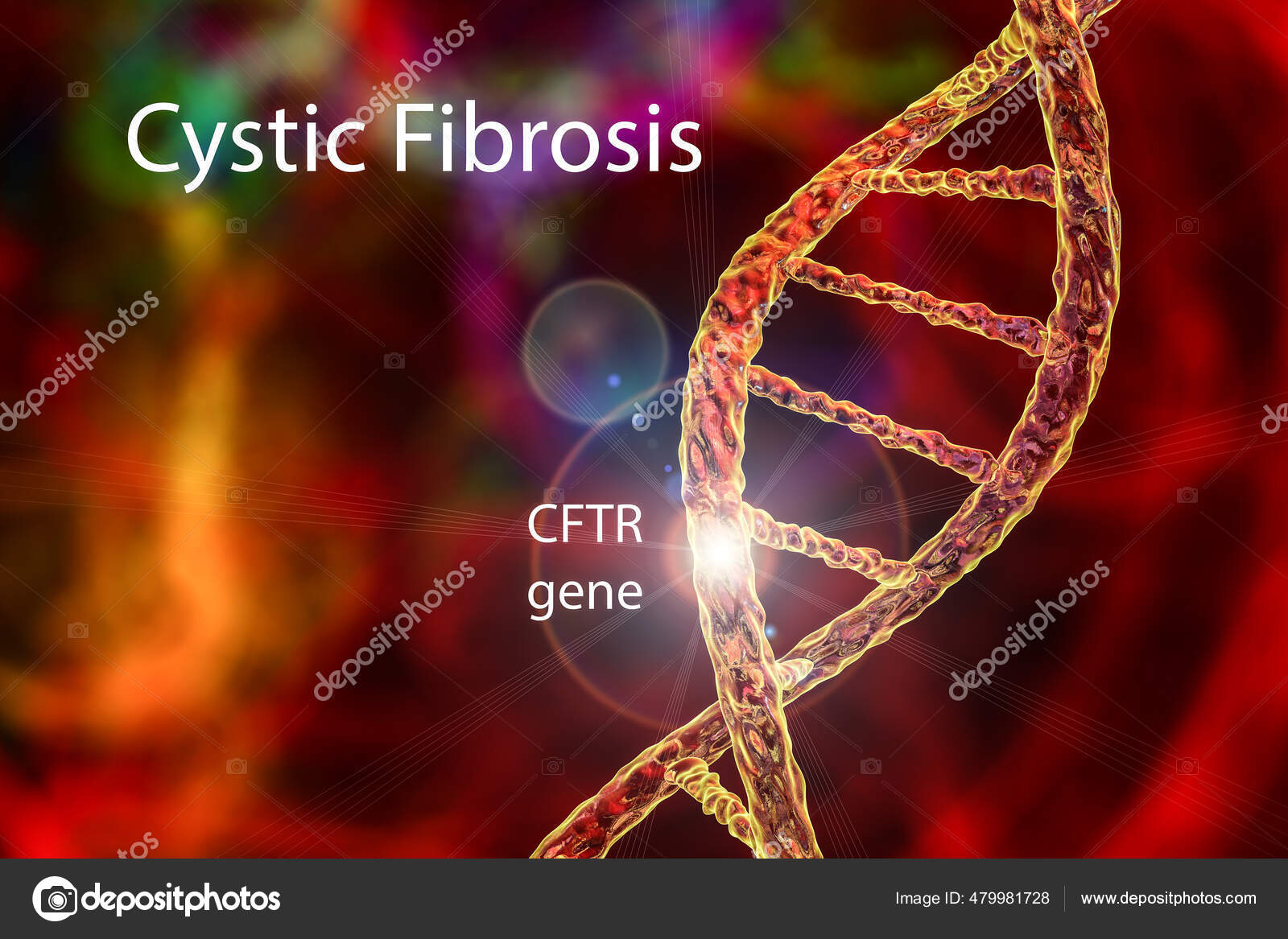 Cystic Fibrosis Genetic Disorder Caused Mutation Cftr Gene Inherited ...