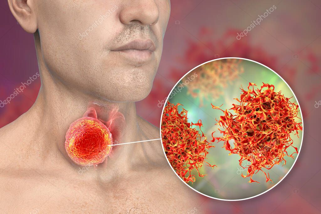 Cáncer de tiroides. Ilustración 3D que muestra la glándula tiroides con ...