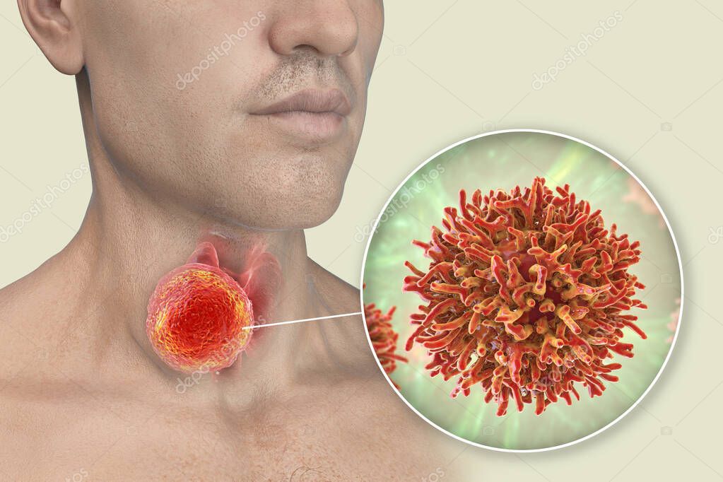 Cáncer de tiroides. Ilustración 3D que muestra la glándula tiroides con ...