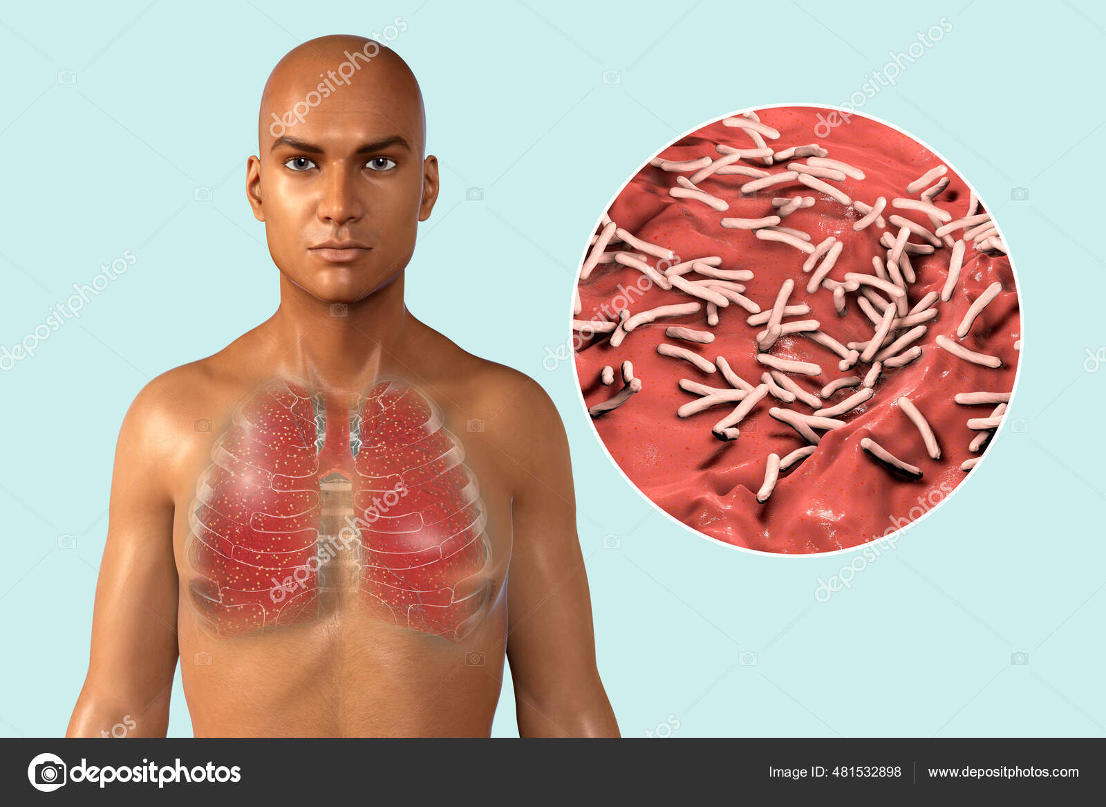 Tuberculosis Pulmonar Una Enfermedad Causada Por Bacterias ...