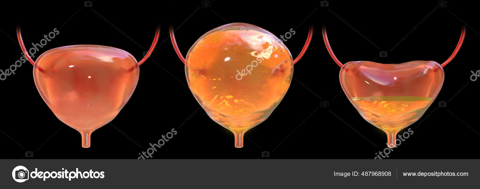 Overactive Bladder Urinary Bladder Empty Normal Full Overactive ...