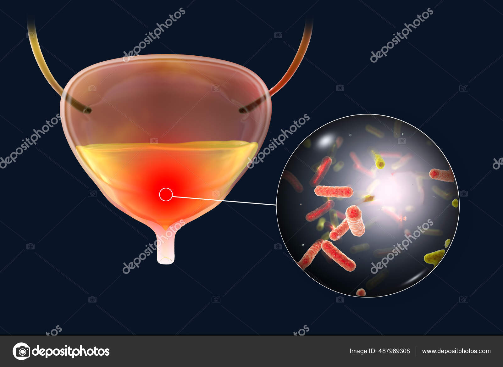 Cystite Infection Bactérienne Vessie Illustration Conceptuelle Montrant ...