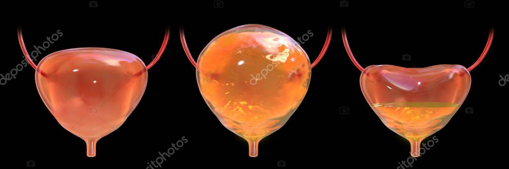 Vejiga hiperactiva. Vejiga urinaria vacía, normal llena, e hiperactiva ...