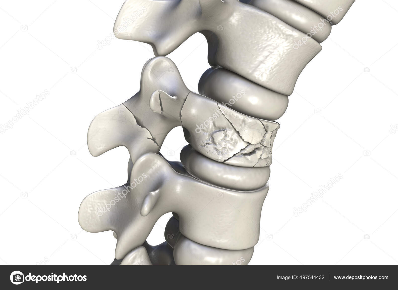 Traumatic Spine Fractures , Spinal fractures – JIFAI