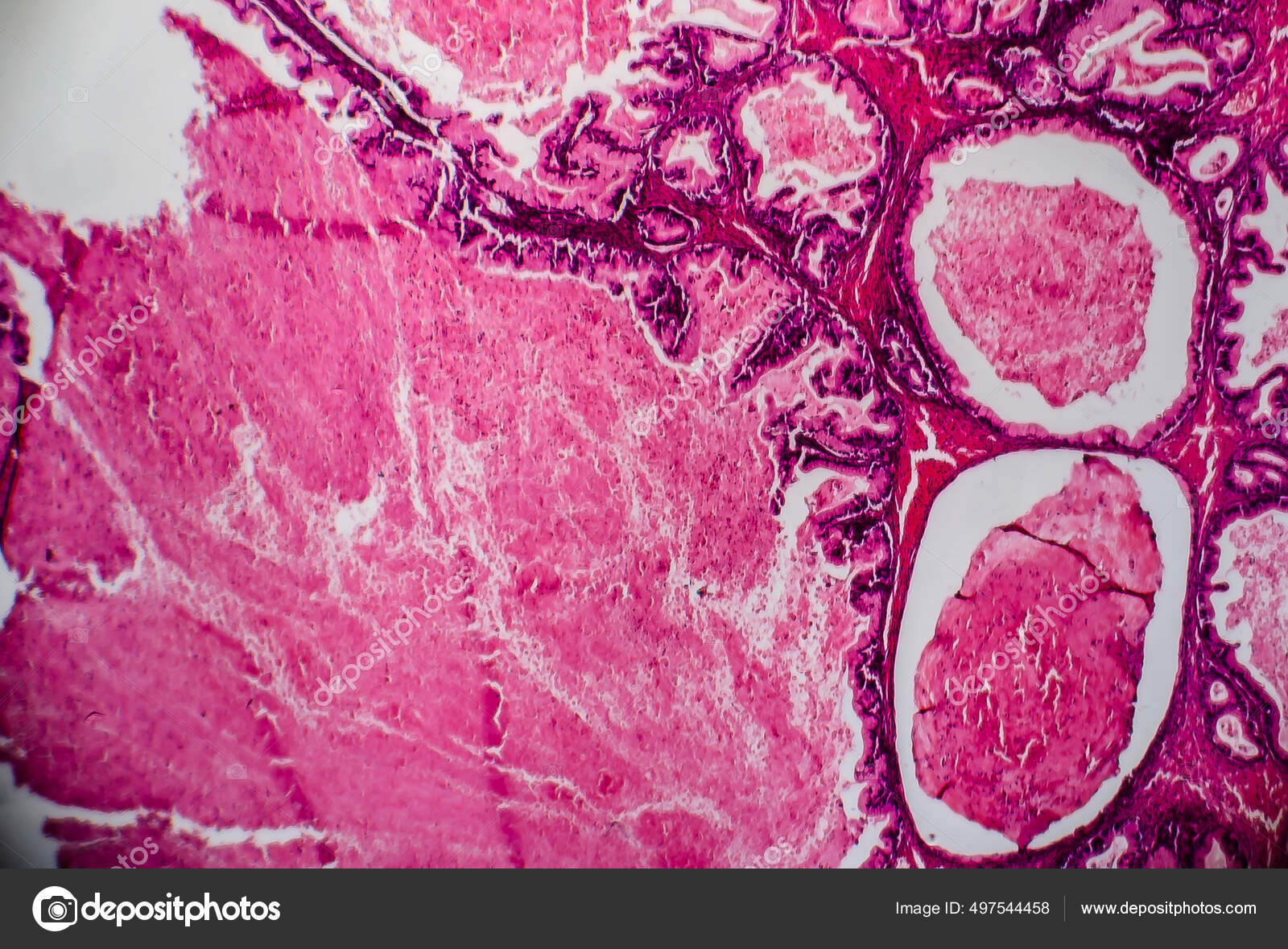Cáncer Ovario Micrografía Ligera Foto Bajo Microscopio Fotografía ...