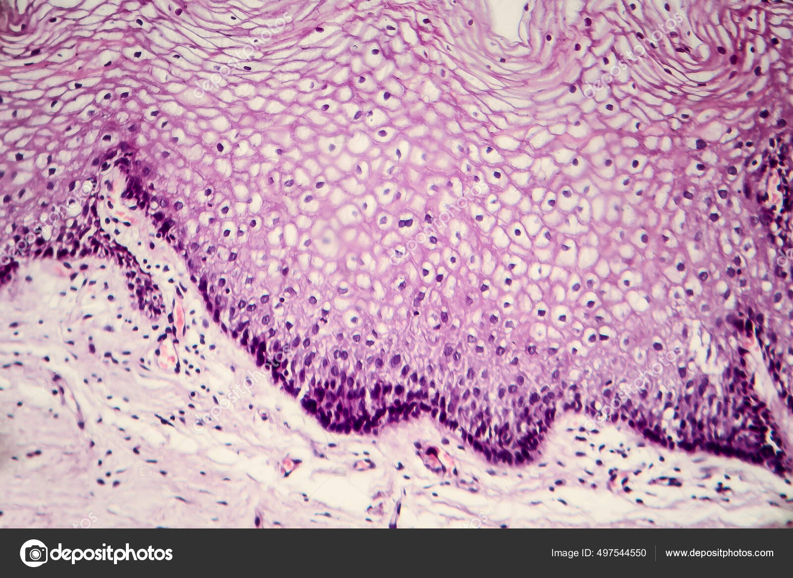 Cáncer Cuello Uterino Micrografía Ligera Biopsia Cervical Foto Bajo ...