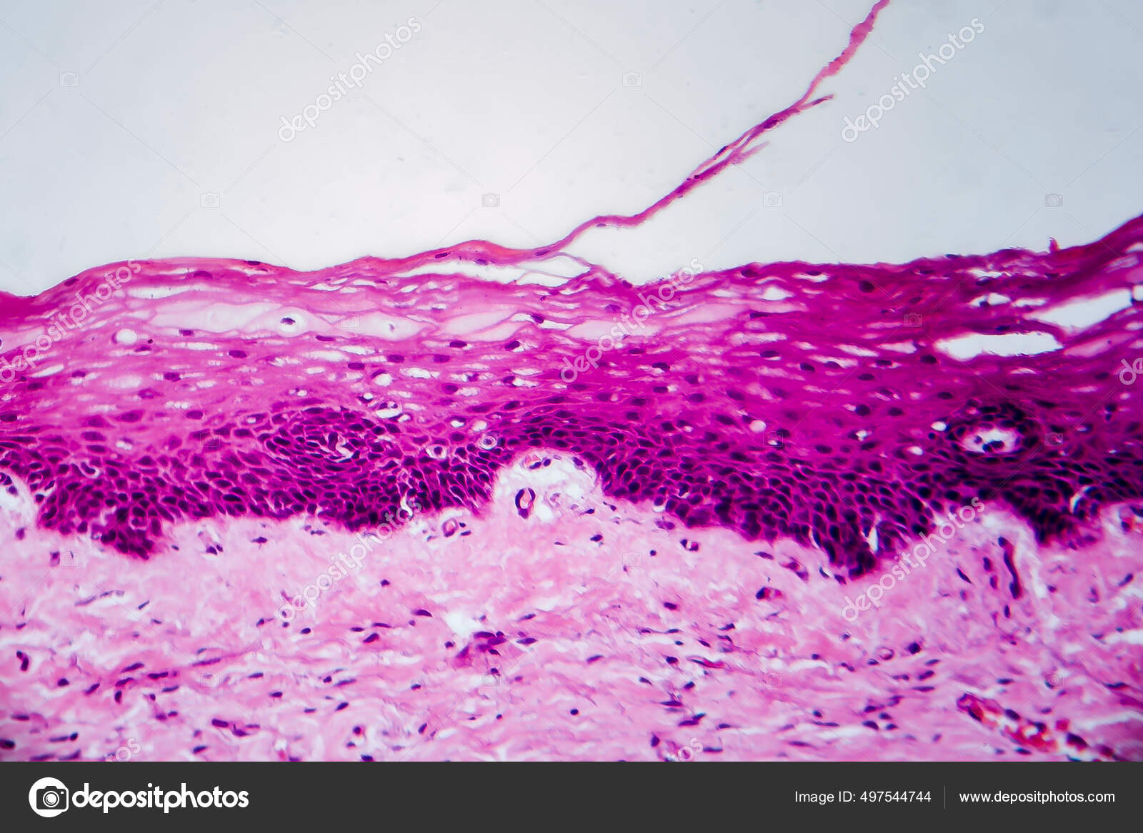 Erosión Cervical También Conocida Como Eversión Ectropión Micrografía ...