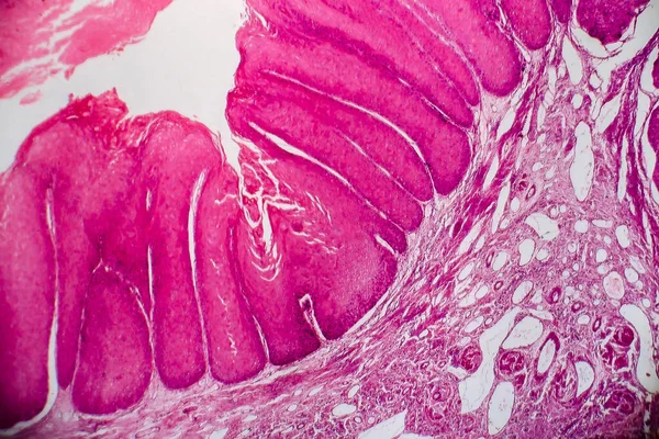 Condyloma Acuminatum Also Known Genital Warts Light Micrograph Photo ...