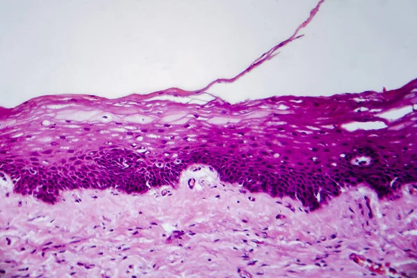 Erosión cervical, también conocida como eversión y ectropión ...