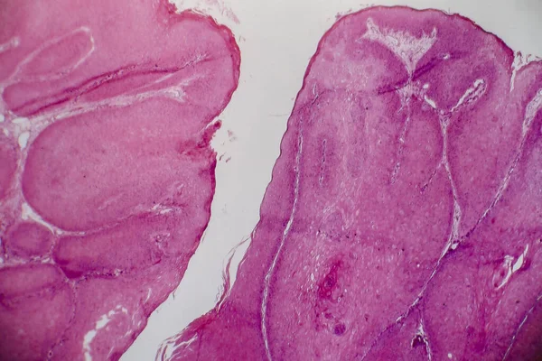 Condyloma Stock Photos, Royalty Free Condyloma Images | Depositphotos