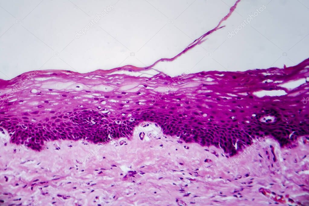 Erosión cervical, también conocida como eversión y ectropión ...