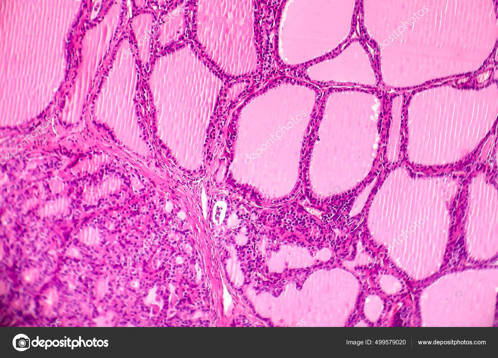 Toxic Diffuse Goiter Graves' Disease Autoimmune Disease Affects Thyroid ...